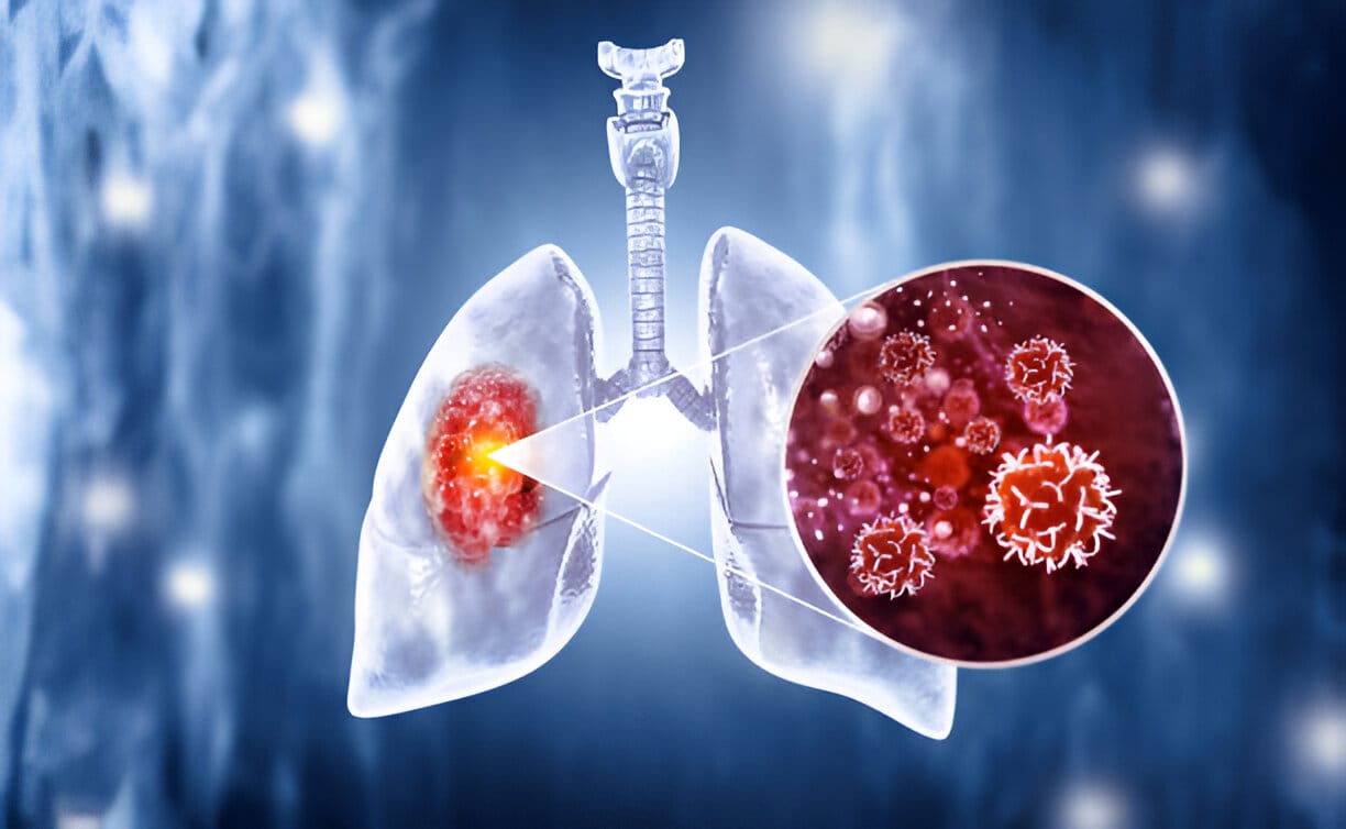 Osimert 80 mg (Osimertinib): Transforming Cancer Care in India ...